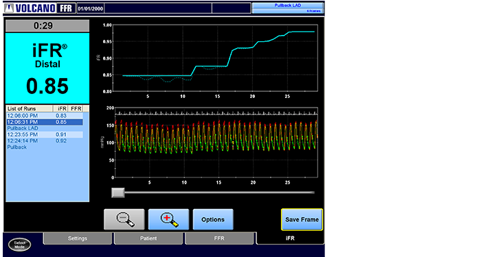 instant wave-Free Ratio (iFR) | Philips Healthcare