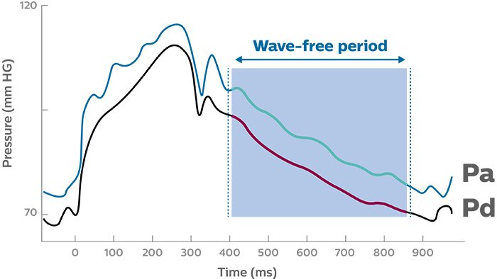 instant wave-Free Ratio (iFR) | Philips Healthcare