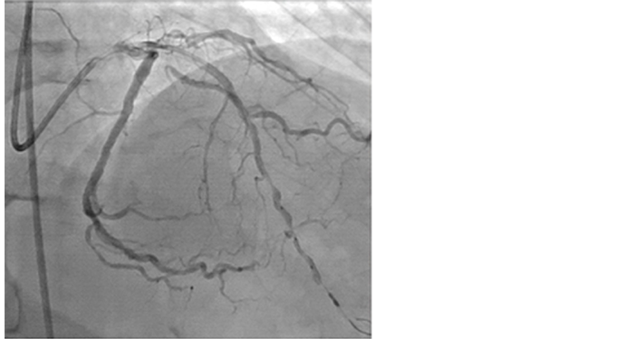 Intravascular Ultrasound (IVUS) | Philips Healthcare