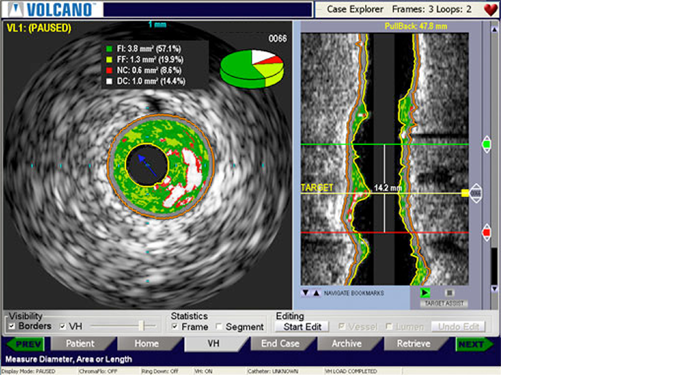 VH IVUS | Philips Healthcare