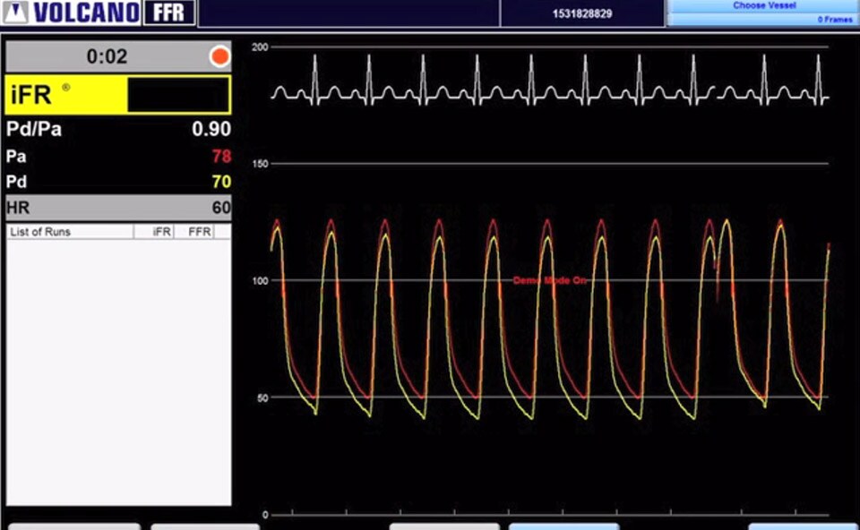 instant wave-Free Ratio (iFR) | Philips Healthcare