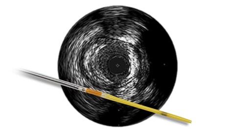 IVUS - Intravascular Ultrasound | Philips Healthcare