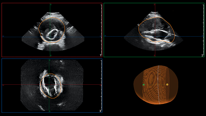 Abdominal Aortic Aneurysm Ultrasound