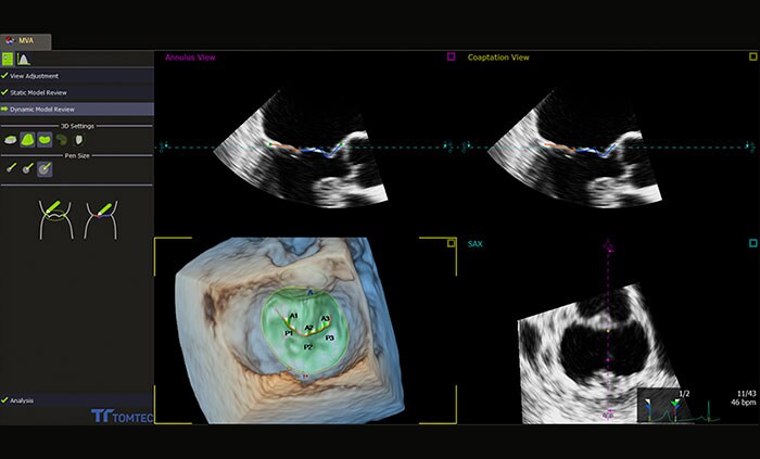 EPIQ CVx Cardiovascular ultrasound system | Philips