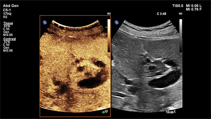 CEUS Contrast-Enhanced Ultrasound | Philips Healthcare