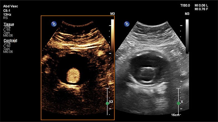 CEUS Contrast-Enhanced Ultrasound | Philips