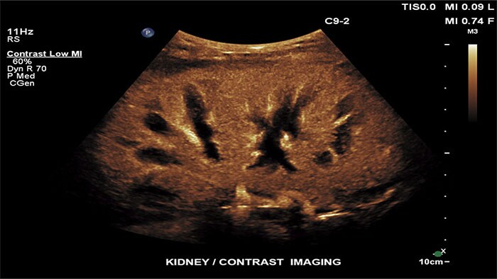CEUS Contrast-Enhanced Ultrasound | Philips Healthcare