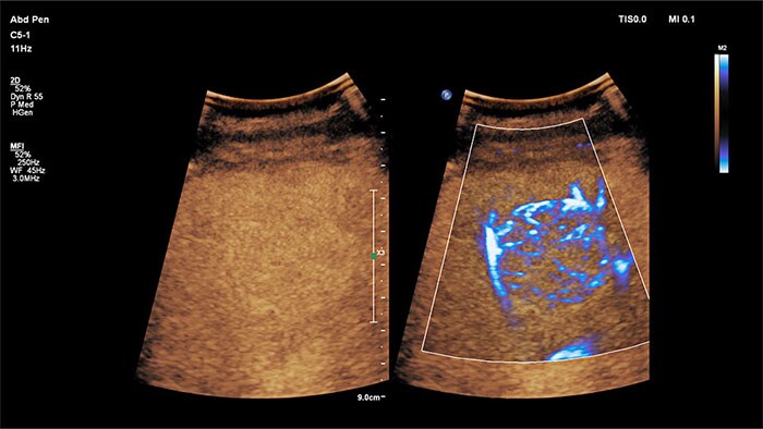 CEUS Contrast-Enhanced Ultrasound | Philips Healthcare
