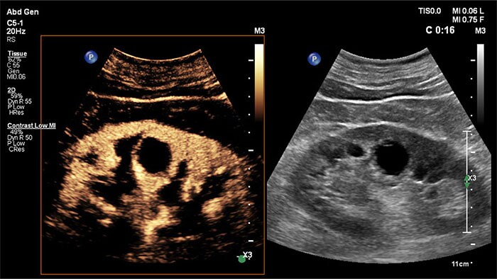CEUS Contrast-Enhanced Ultrasound | Philips Healthcare