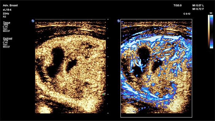 CEUS Contrast-Enhanced Ultrasound | Philips