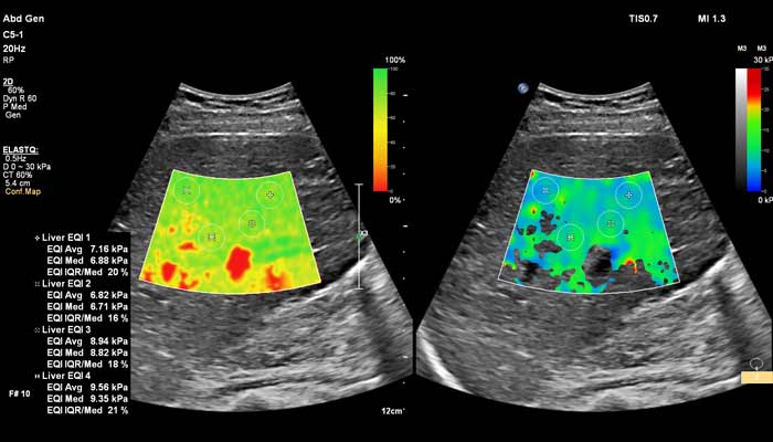 Shear Wave Ultrasound Liver Assessment | Philips Ultrasound