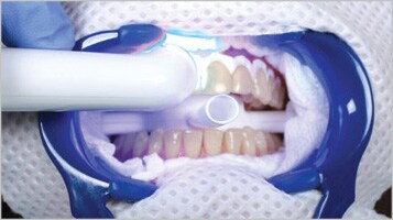 Teeth whitening kits by Dash | Dental Professional