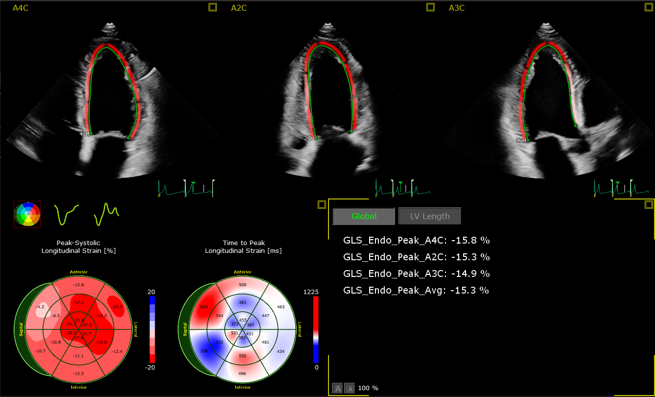New automation capabilities for Philips EPIQ CVx cardiology ultrasound ...