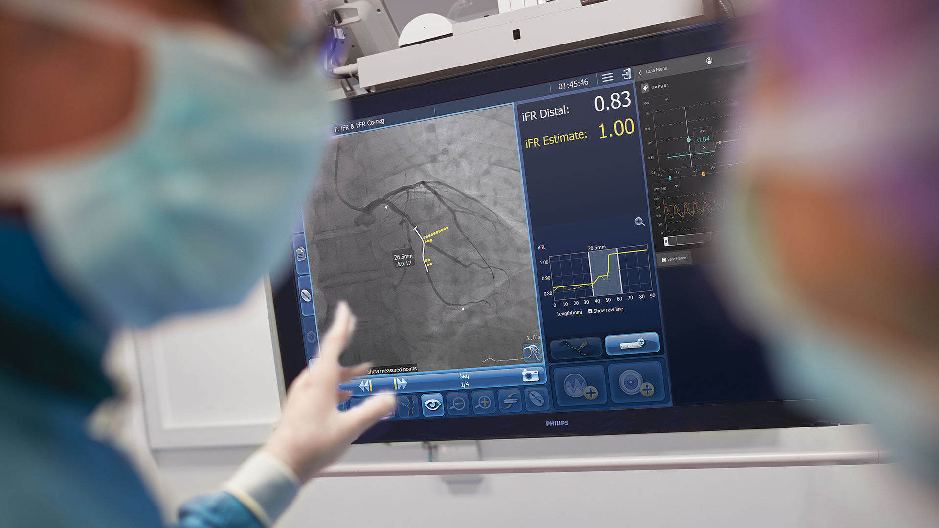 New automation capabilities for Philips EPIQ CVx cardiology ultrasound ...