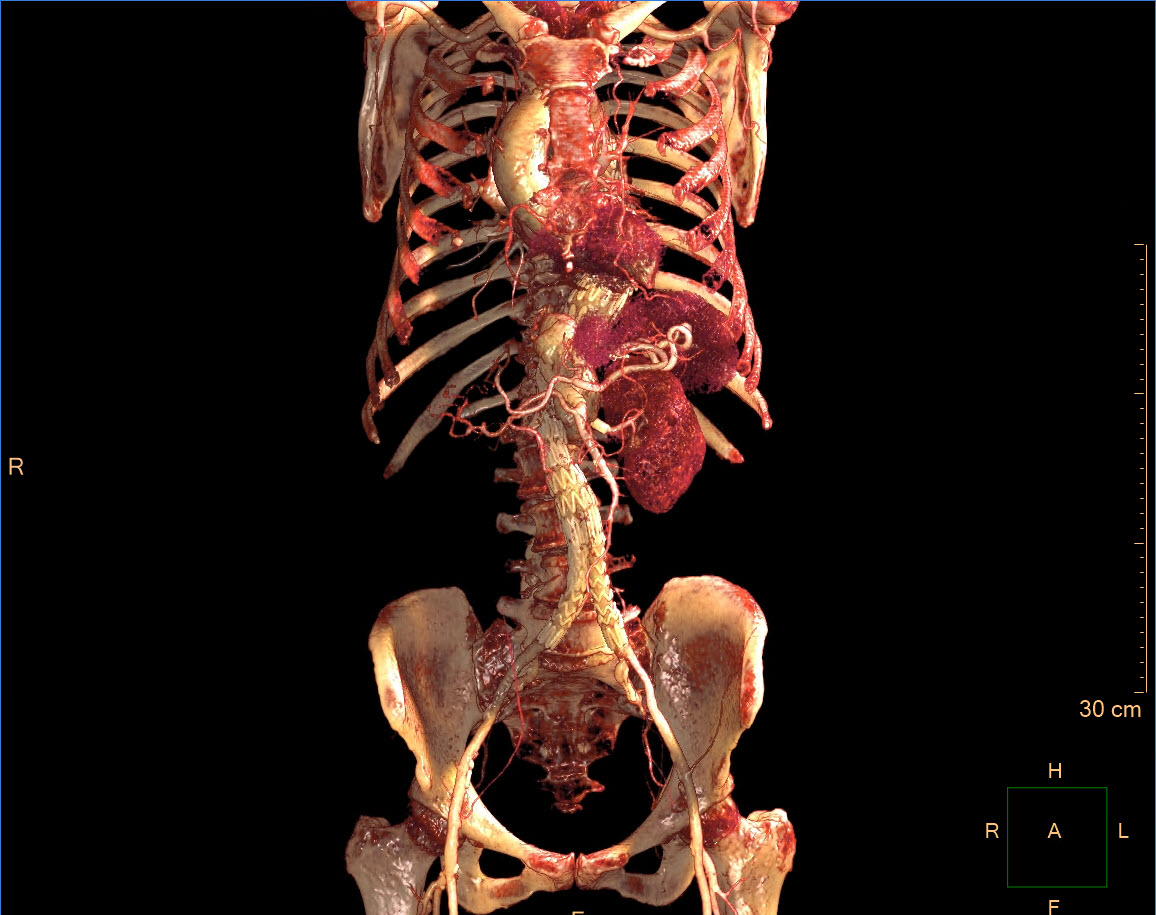 Philips introduces IntelliSpace Portal 12 - News | Philips