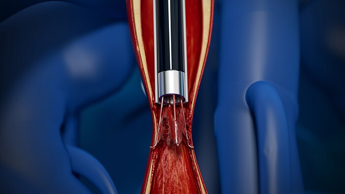 Solid core OmniWire pressure guide wire - News | Philips